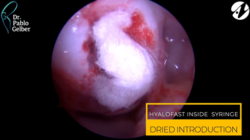 Dr. Gelber - NanoFx + Hyalofast In Knee OCD - Anika Therapeutics