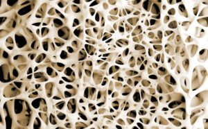Tactoset Injectable Bone Substitute | Anika